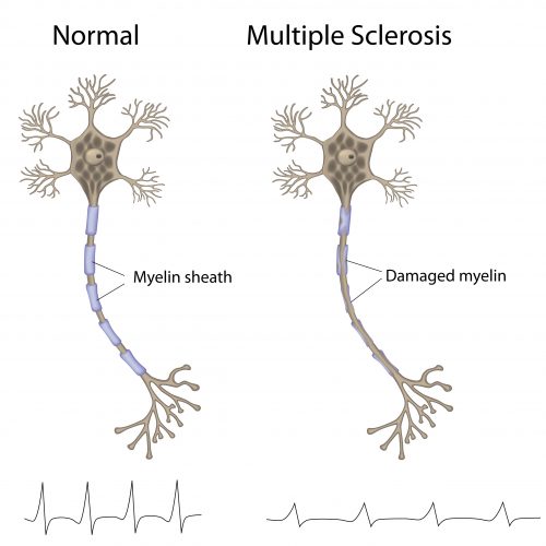 What Is Multiple Sclerosis? | MS | Critical Care Training Center